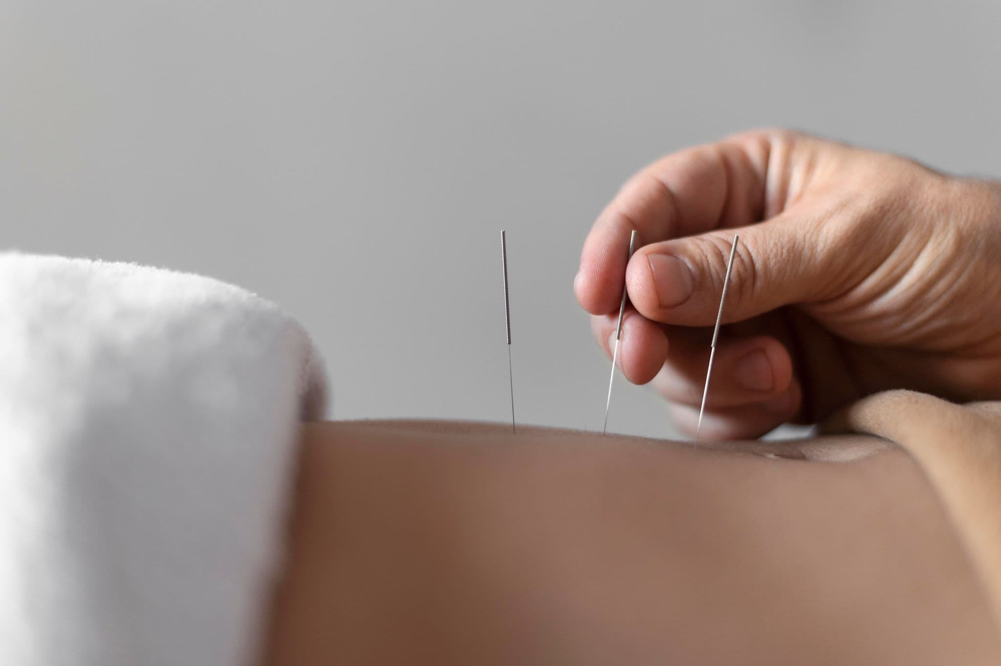 Acupuncture Needle Sizes: How to Choose the Right One