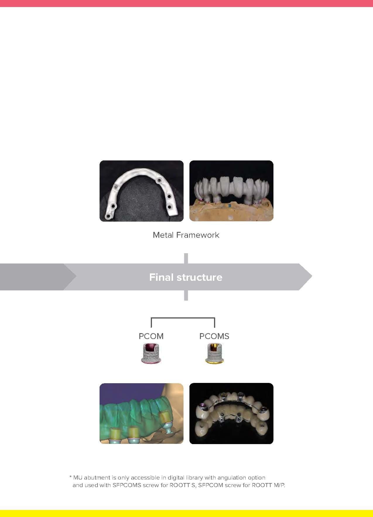 Workflow ROOTT P - Tissue level Implant