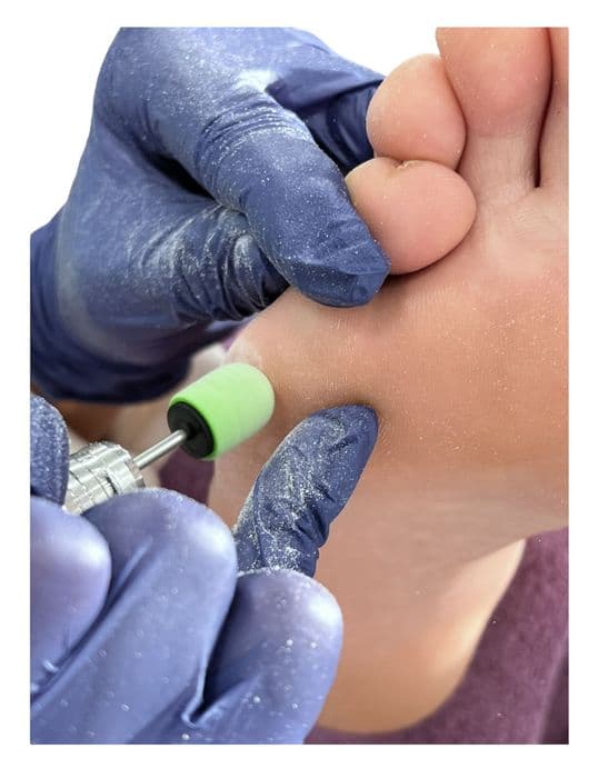 Treating Corns and Calluses