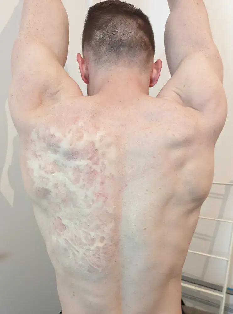 Burn Prosthetic | Silicone (Large) | Mouldlife